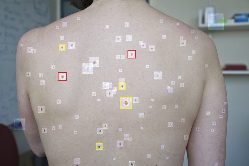 Using computer vision to catch early-stage skin cancer | Radar ...