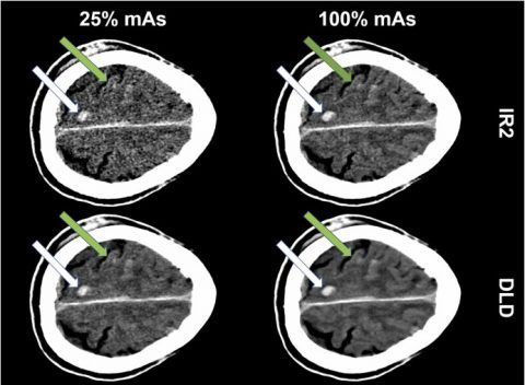 AI Algorithm reduces unnecessary radiation exposure in traumatic ...